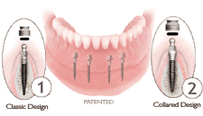 Denture Implants - IMTEC Technology Milwaukee - Hampton Dental Associates