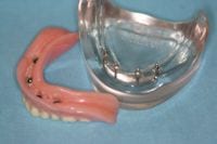 Denture Implants - IMTEC Technology Milwaukee - Hampton Dental Associates