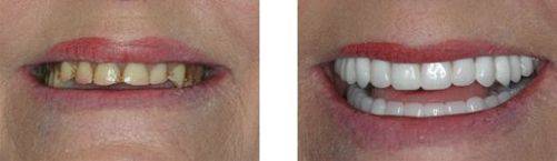 Dentist | Denture Replacement in Milwaukee | Hampton Dental Associates