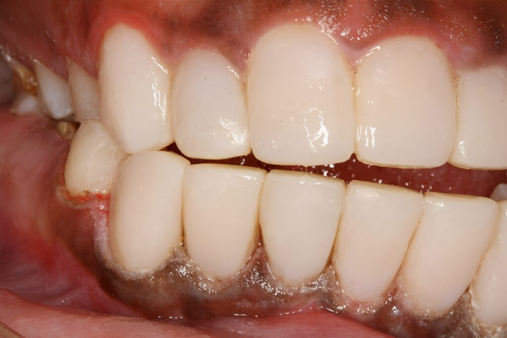 Genetic Dental Defects Milwaukee - Tooth Defects Milwaukee