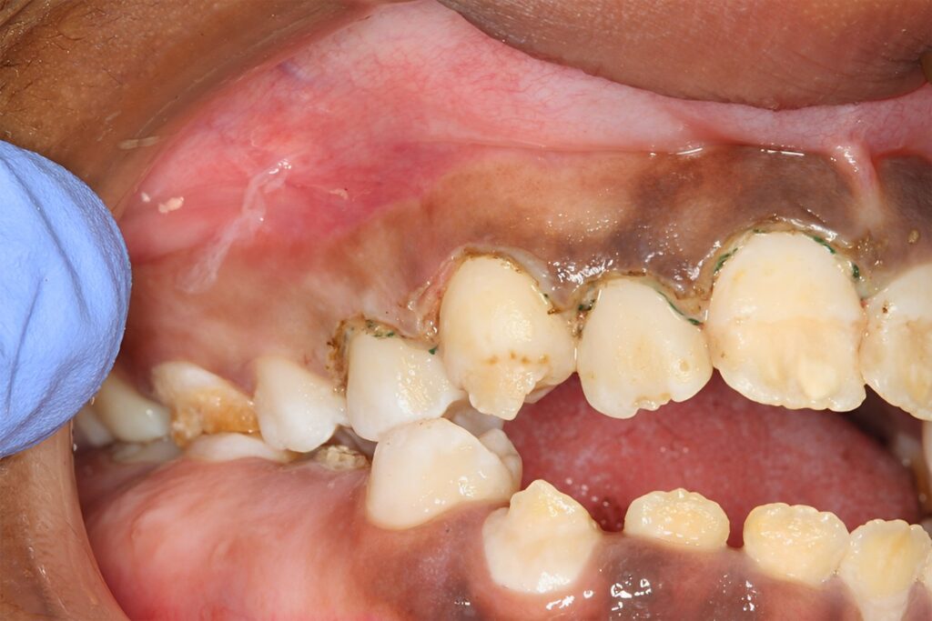 Genetic Dental Defects Milwaukee - Tooth Defects Milwaukee