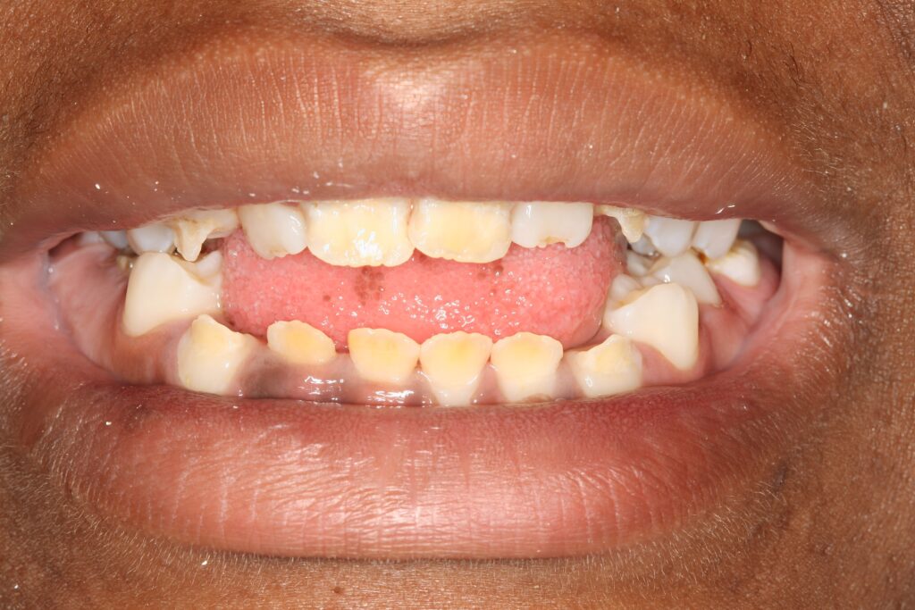 Genetic Dental Defects Milwaukee - Tooth Defects Milwaukee